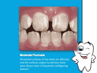 Dental Fluorosis | PPTX