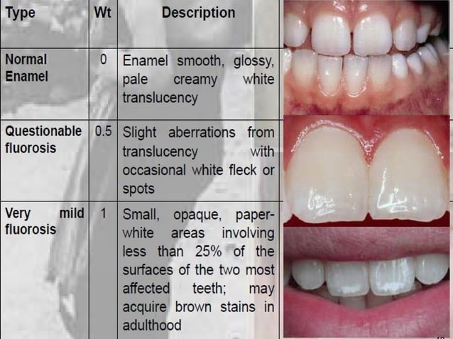 Fluorosis | PPT