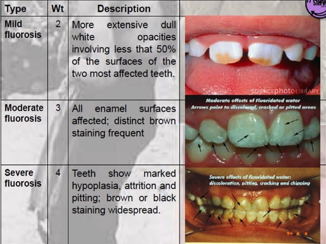 Fluorosis | PPT