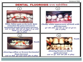 Fluorosis | PPTX