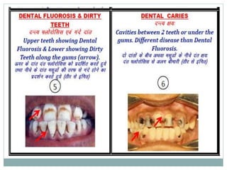 Fluorosis | PPTX