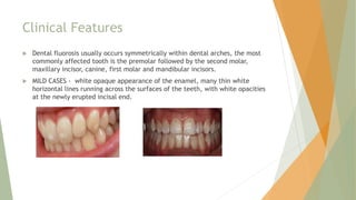 Dental Fluorosis | PPTX