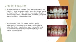 Dental Fluorosis | PPTX