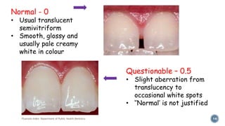 Fluorosis index | PPTX