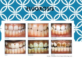 Fluorosis original | PPTX