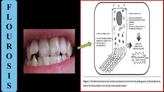 Dental Fluorosis - SELVI | PPTX