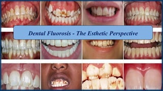 Dental Fluorosis - SELVI | PPTX