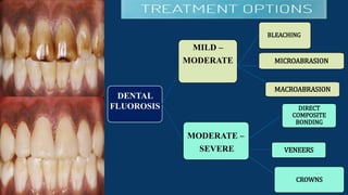 Dental Fluorosis - SELVI | PPT