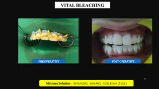 Dental Fluorosis - SELVI | PPT