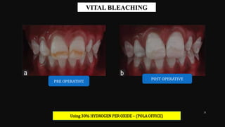 Dental Fluorosis - SELVI | PPTX