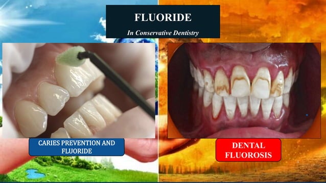 Dental Fluorosis - SELVI | PPT
