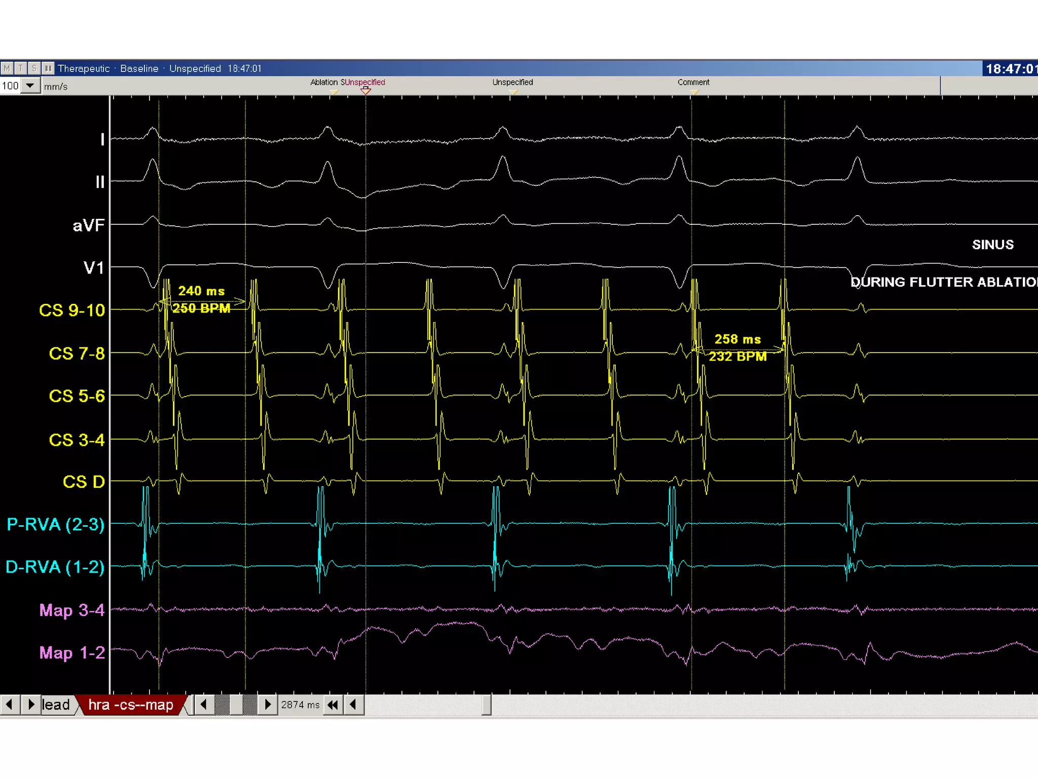 Flutter Ablation 2018 | PPT