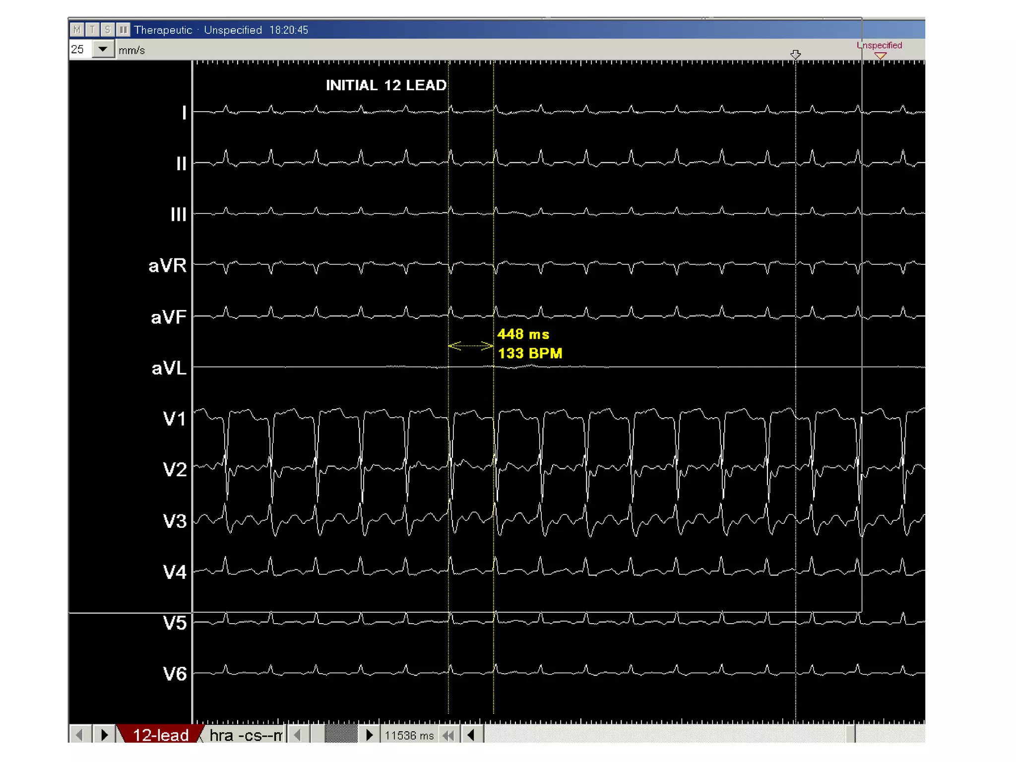 Flutter Ablation 2018 | PPT