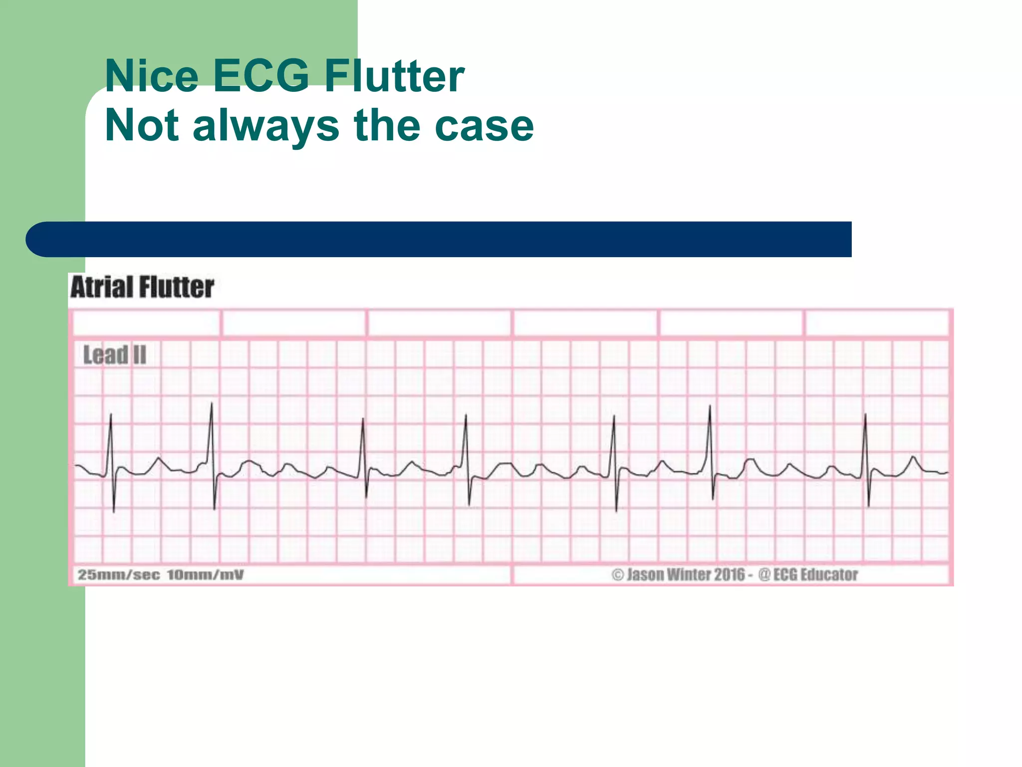 Flutter Ablation 2018 | PPT