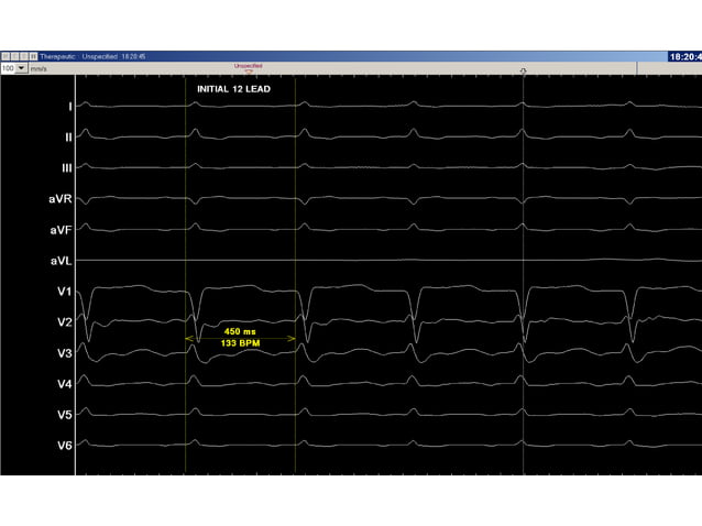 Flutter Ablation 2018 | PPT