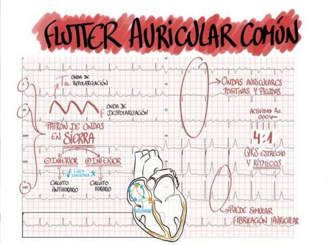 Fluter auricular.pptx