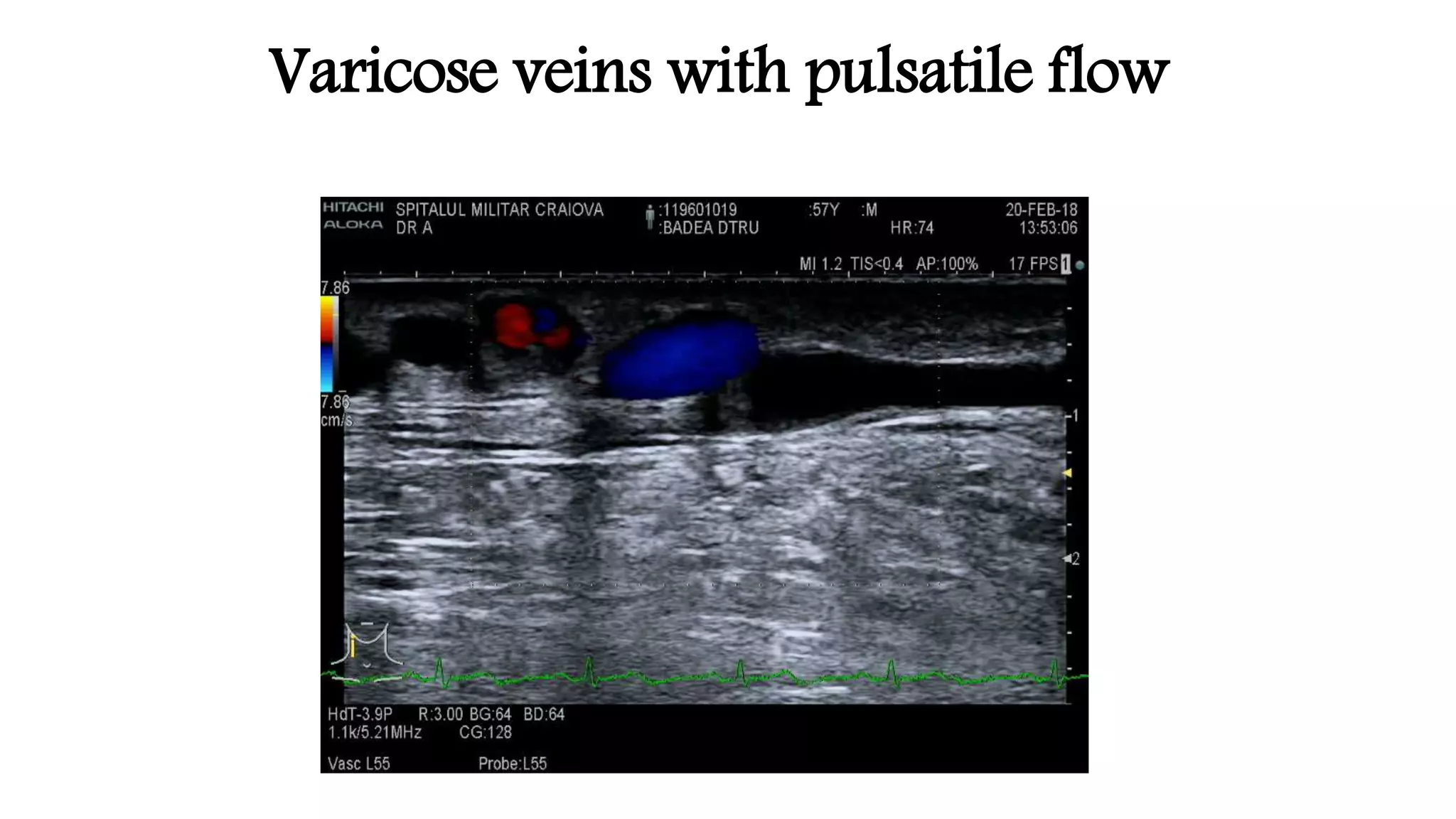 PULSATILE VENOUS FLOW IN LEGS | PPT