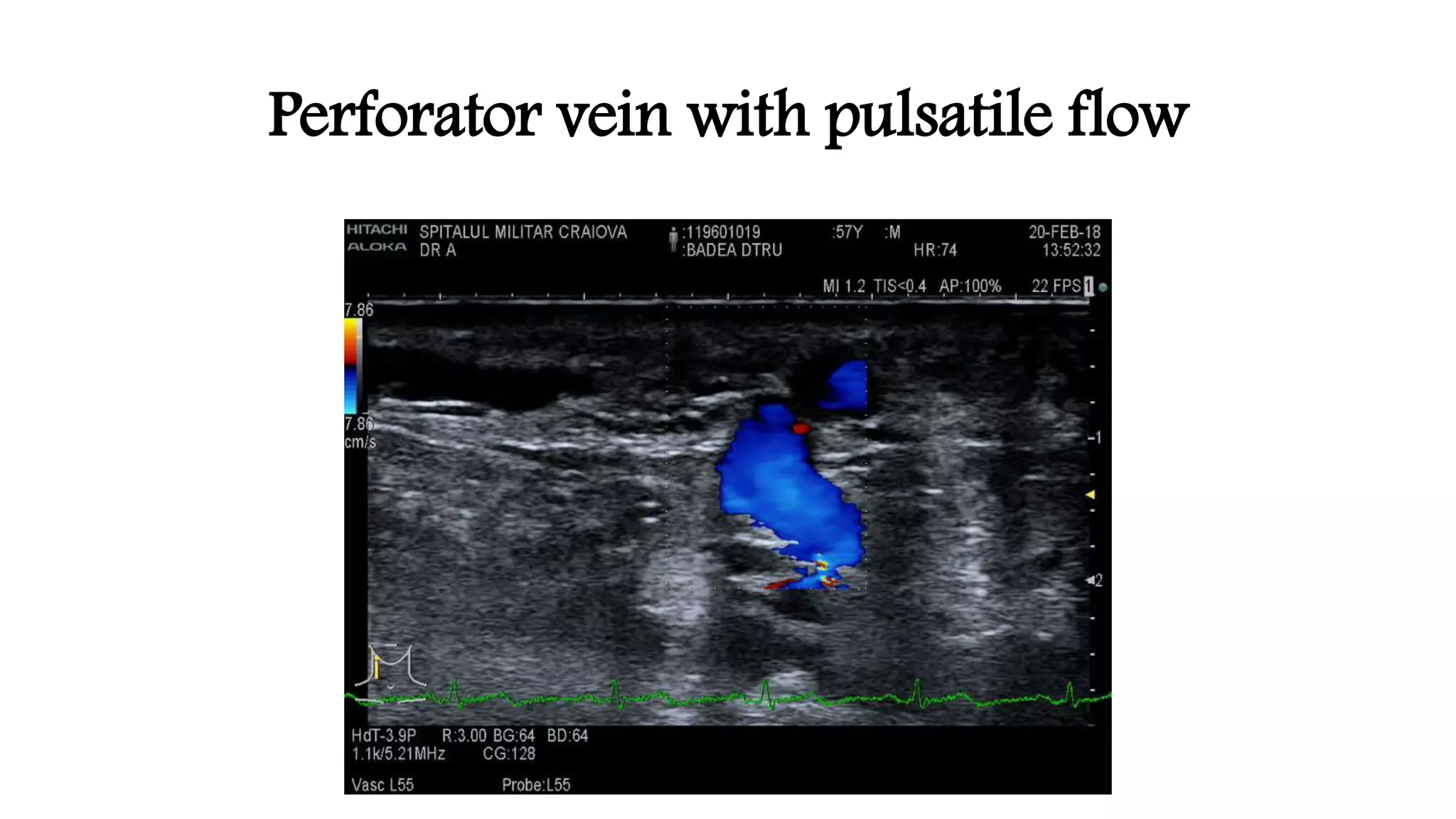 PULSATILE VENOUS FLOW IN LEGS | PPT