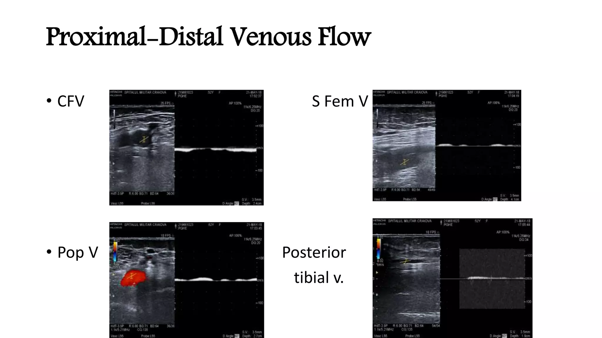 PULSATILE VENOUS FLOW IN LEGS | PPT