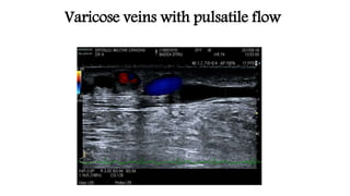 PULSATILE VENOUS FLOW IN LEGS | PPT
