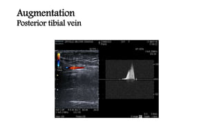 PULSATILE VENOUS FLOW IN LEGS | PPT