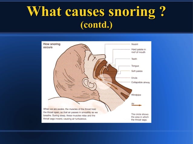 Snoring | ODP | Ear, Nose and Throat Conditions | Diseases and Conditions