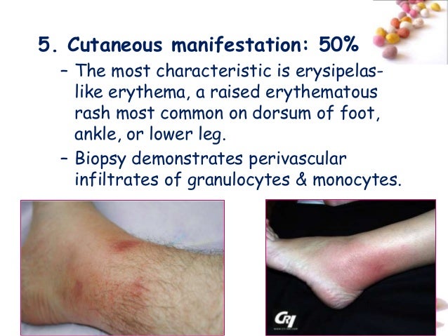 Familial Mediterranean fever