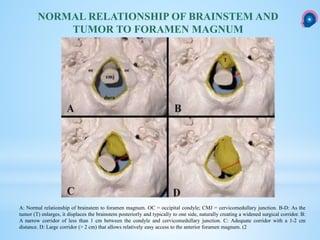 Foramen Magnum Meningioma | PPTX