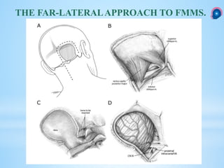 Foramen Magnum Meningioma | PPTX