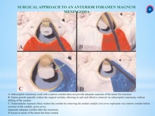 Foramen Magnum Meningioma | PPTX