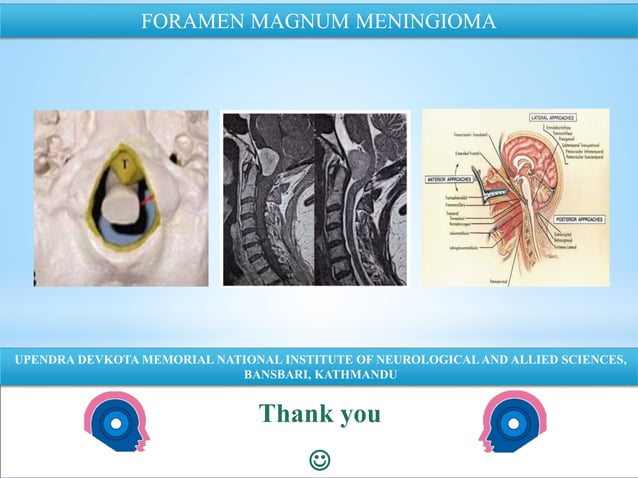 Foramen Magnum Meningioma | PPTX