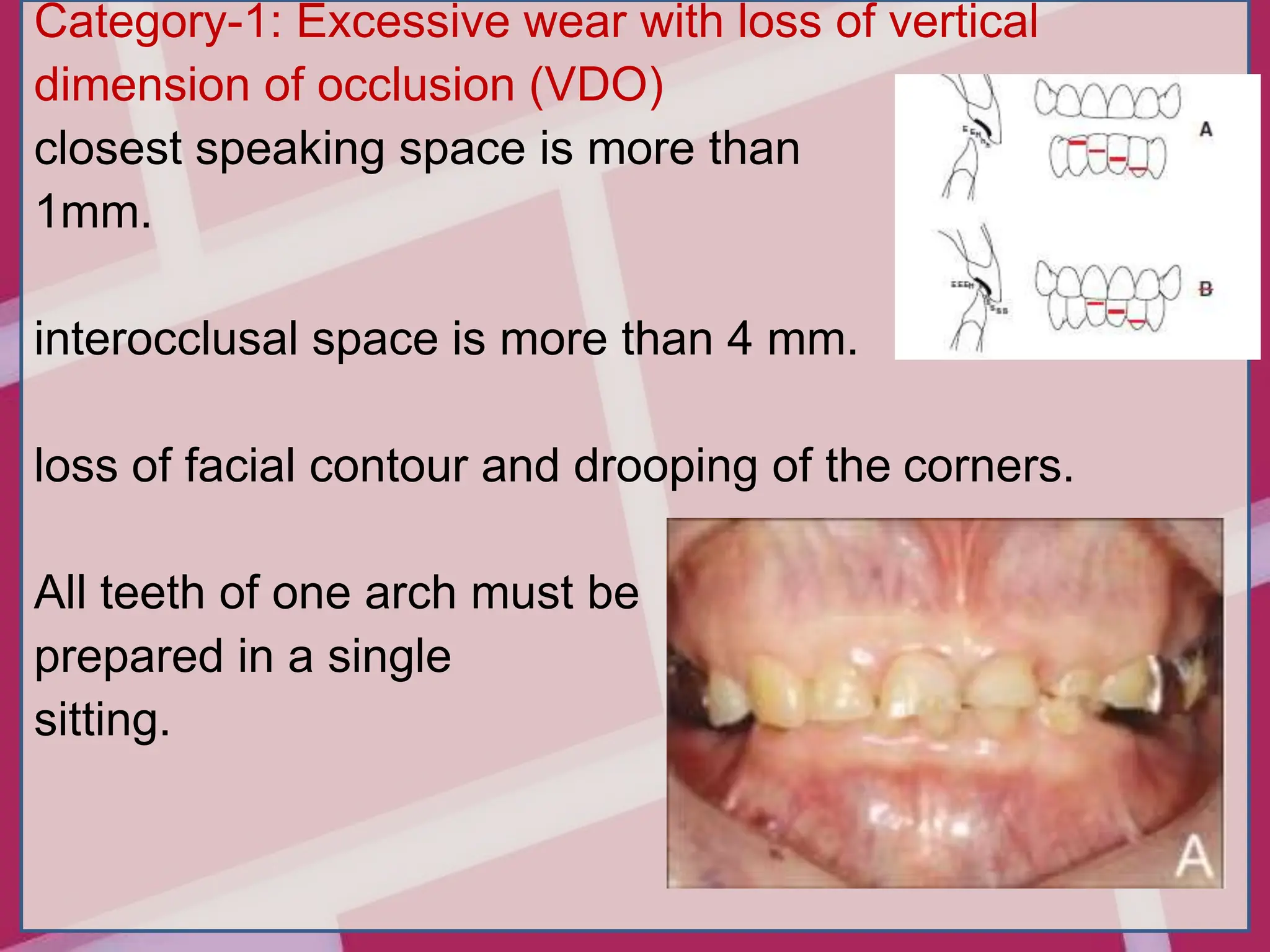 full mouth rehabilitation ppt including all | PPTX