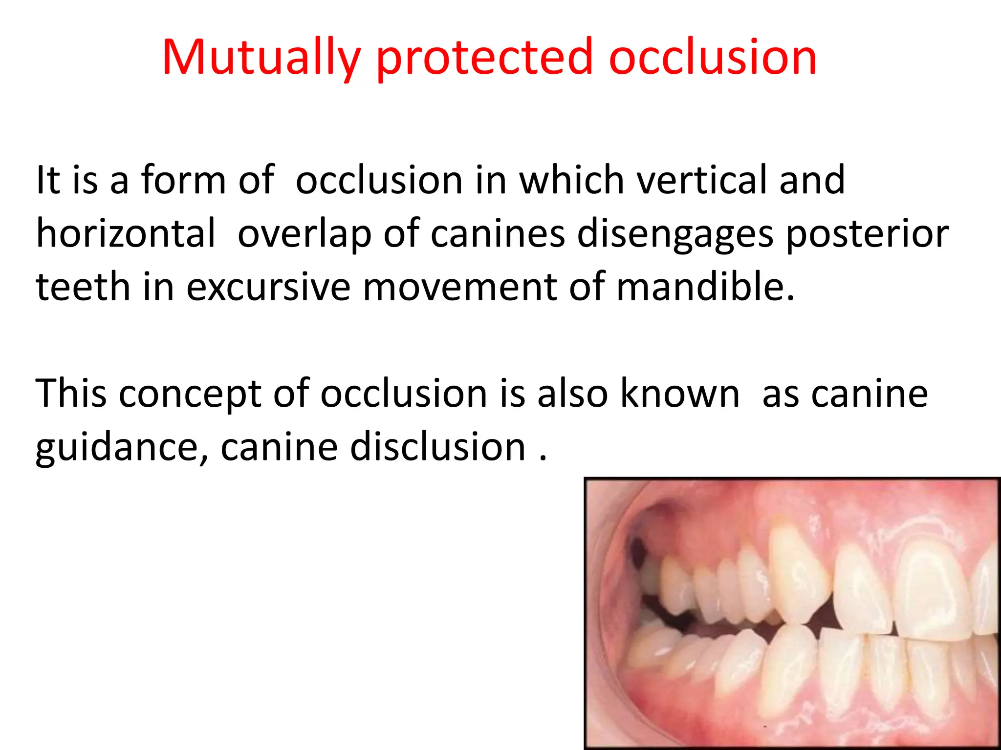 full mouth rehabilitation ppt including all | PPTX