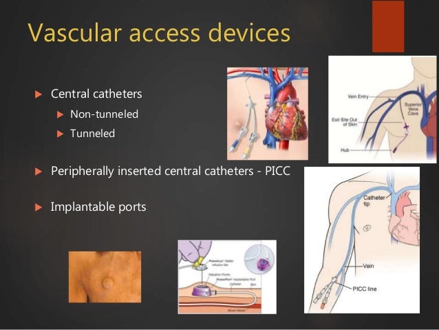 Non Tunneled Central Venous Catheter