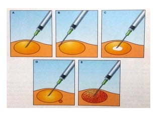 FINE NEEDLE ASPIRATION CYTOLOGY / FNAC | PPTX