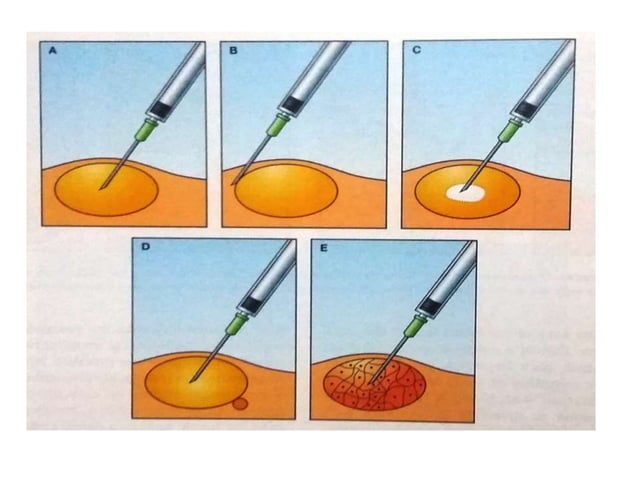 FINE NEEDLE ASPIRATION CYTOLOGY / FNAC | PPTX