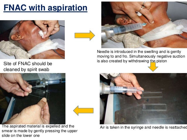 FINE NEEDLE ASPIRATION CYTOLOGY / FNAC FINE NEEDLE ASPIRATION CYTOLOGY / FNAC