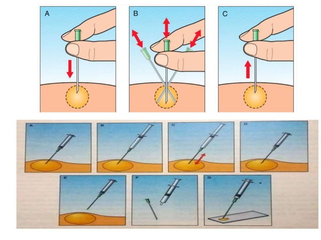 Fine needle aspiration cytology | PPTX | Medical Tests | Medical Health