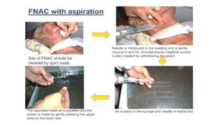 Fine Needle Aspiration Cytology, PATHOLOGY, CYTOLOGY | PPTX