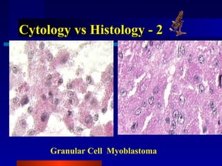 Fine needle aspiration cytology biopsy ppt | PPT