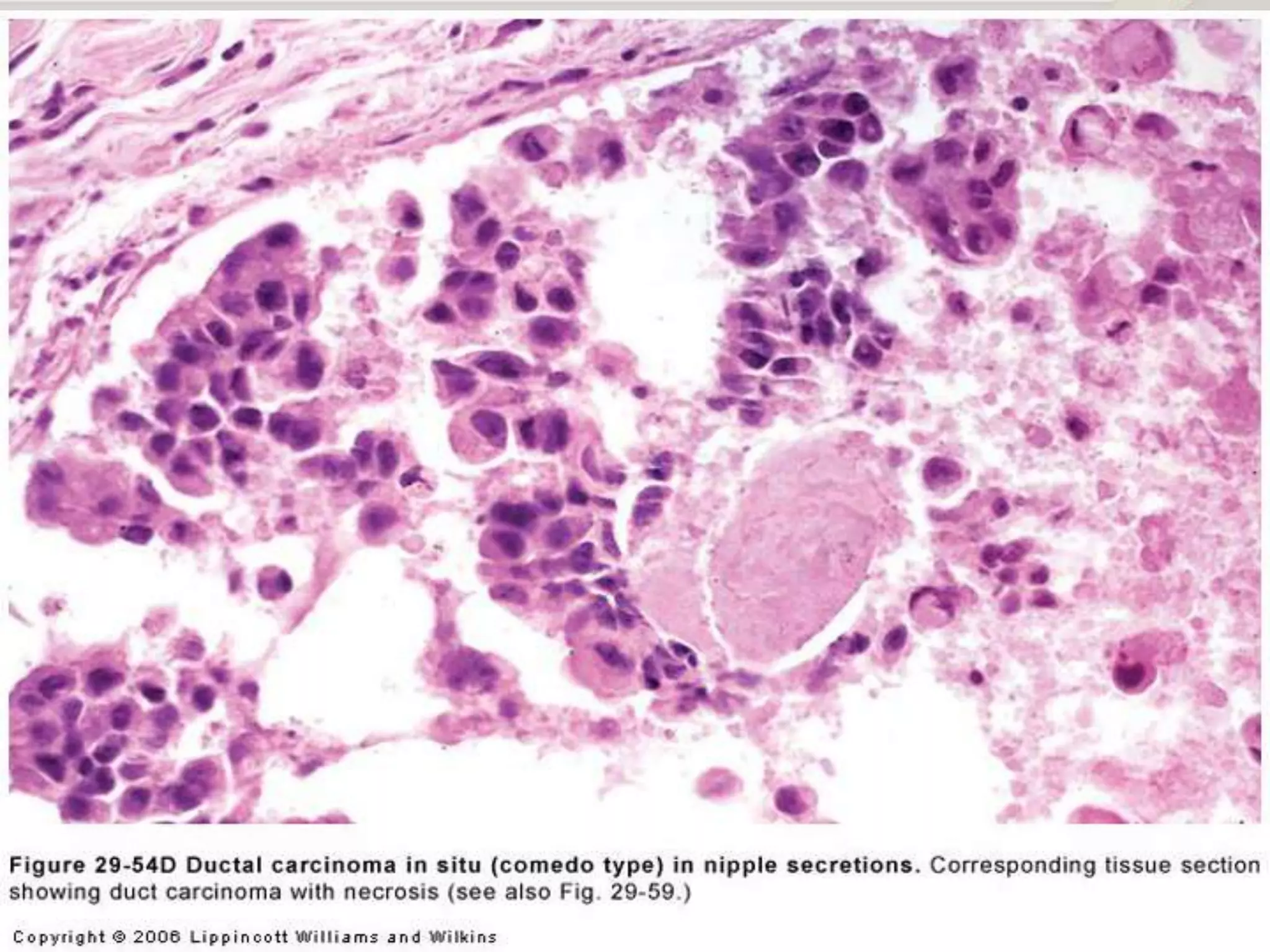 Fnac breast | PPTX