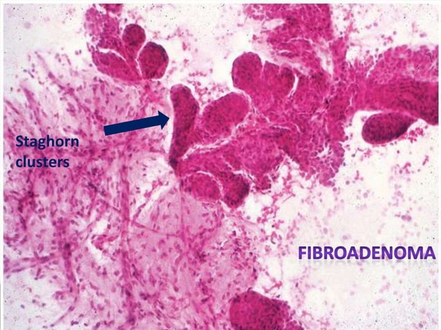 Fnac breast | PPTX | Cancer | Diseases and Conditions