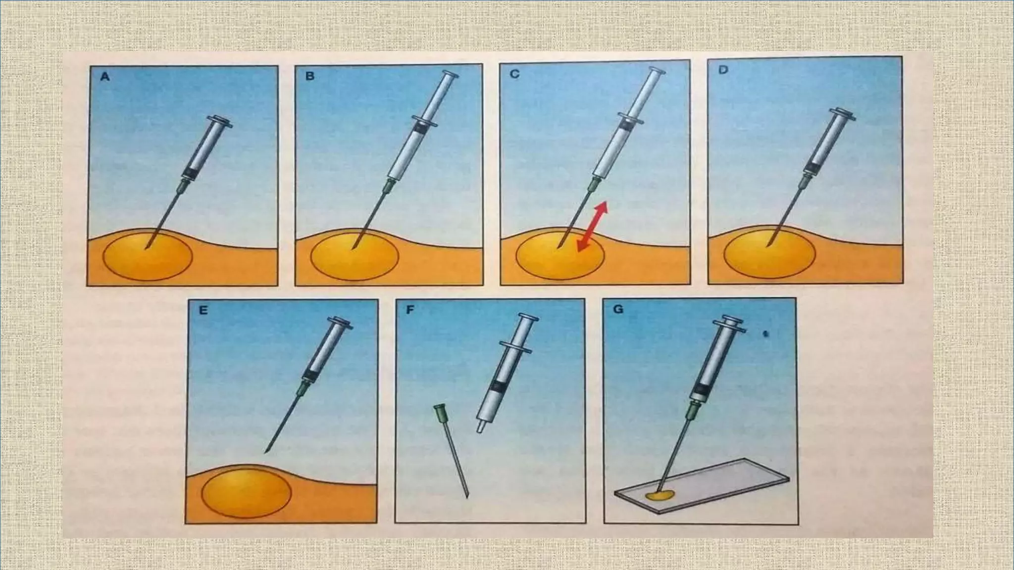 Fine Needle Aspiration Cytology (FNAC) | PPTX