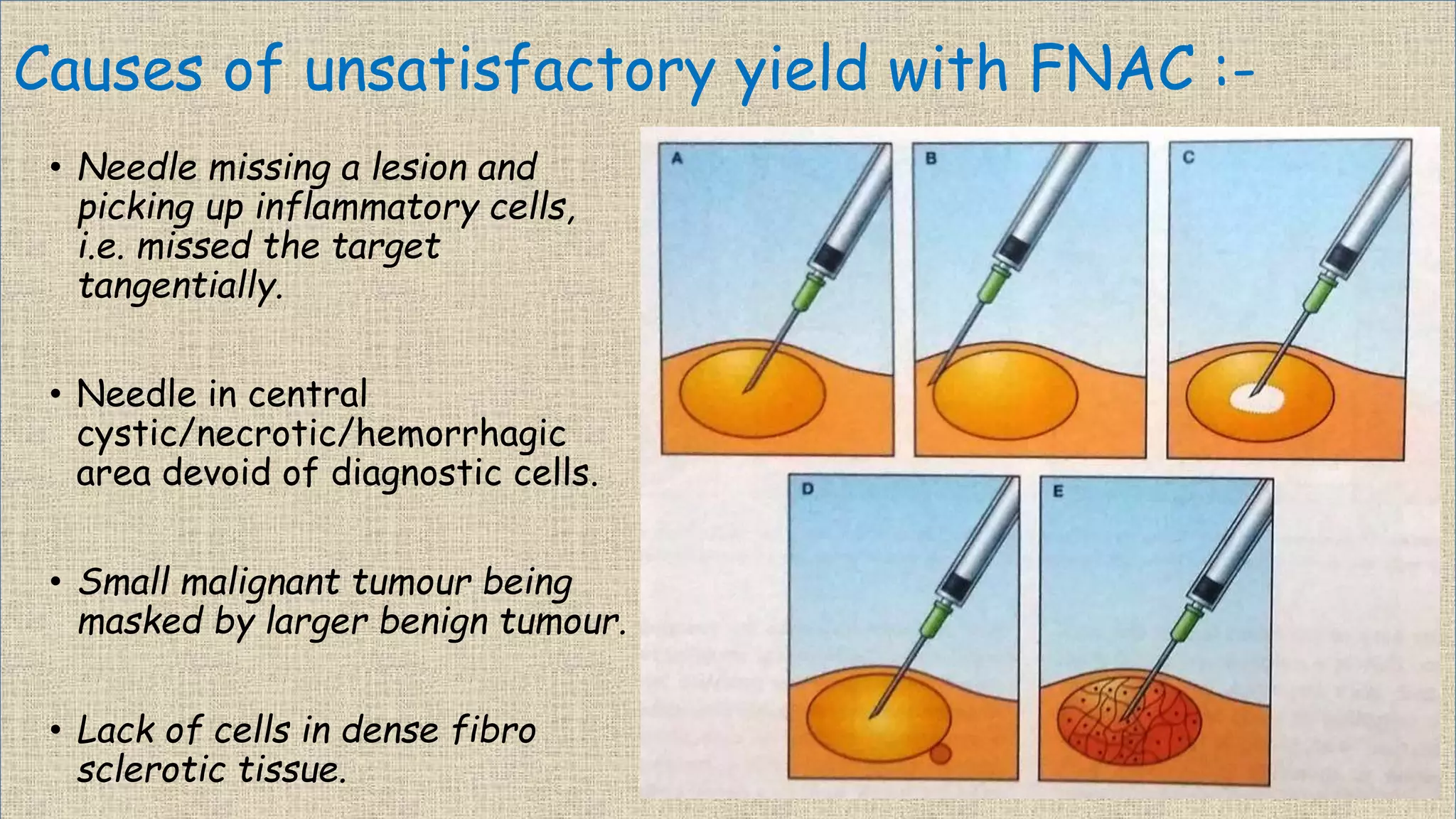 Fine Needle Aspiration Cytology (FNAC) | PPTX