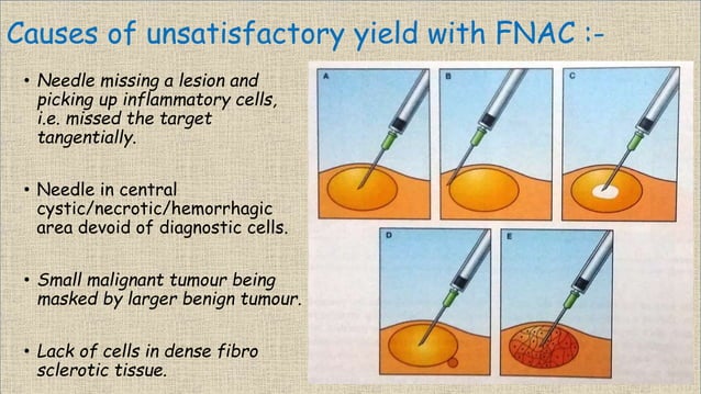 Fine Needle Aspiration Cytology (FNAC) | PPTX | Dental Health ...