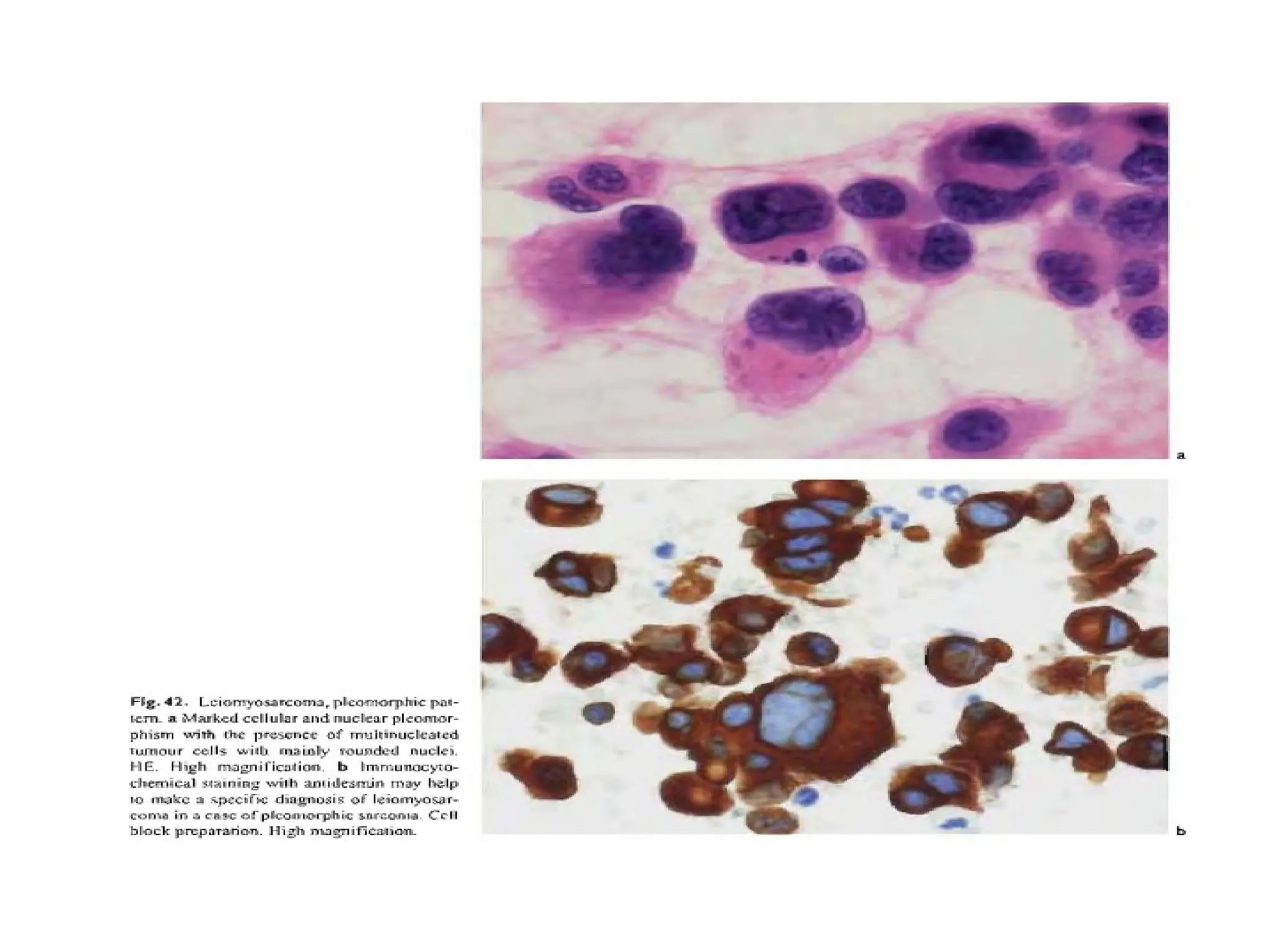 fnac of soft tissue tumors.pptx CYTOPATHOLOGIST | PPTX