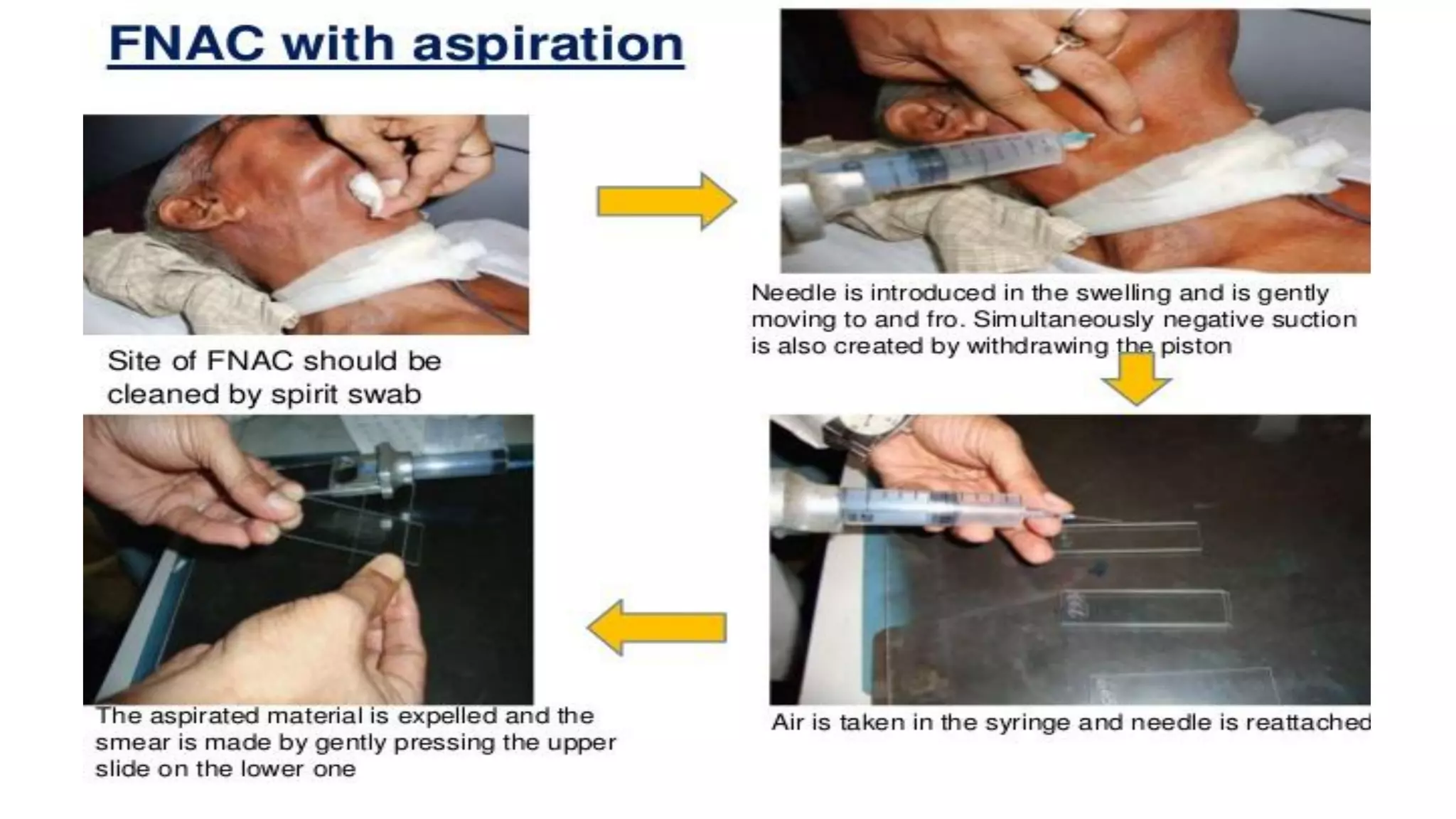 FNAC fine needle aspiration cytology | PDF
