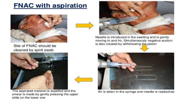 FNAC fine needle aspiration cytology | PDF