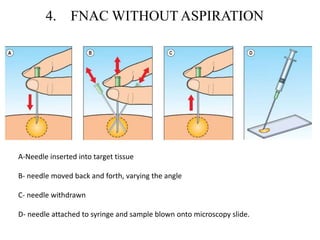 FNAC SEMINAR.pptx fine needle aspiration | PPTX
