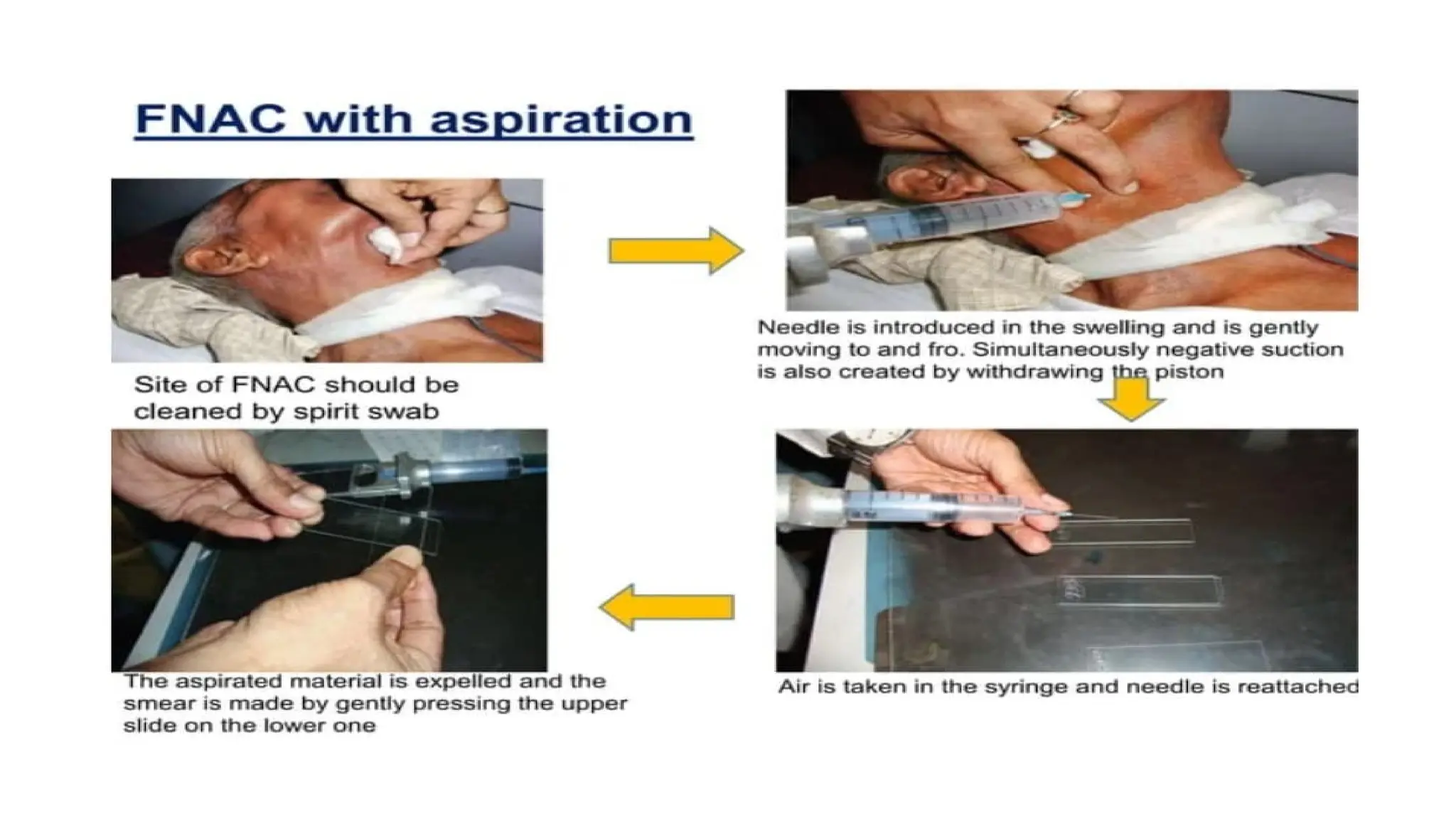 Fine needle aspiration cytology fnac pathology | PPTX